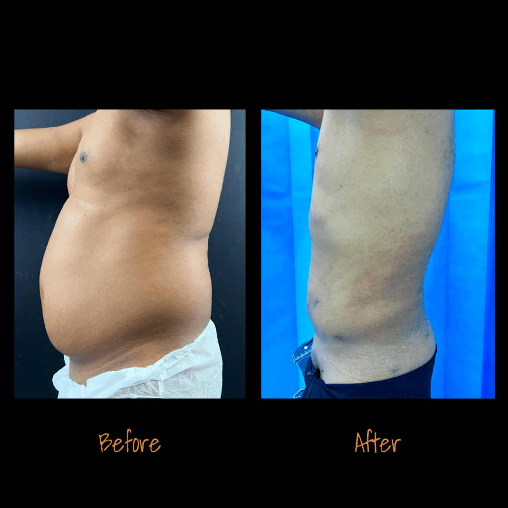 Abdomen, Flanks and Bra Rolls - Purbey