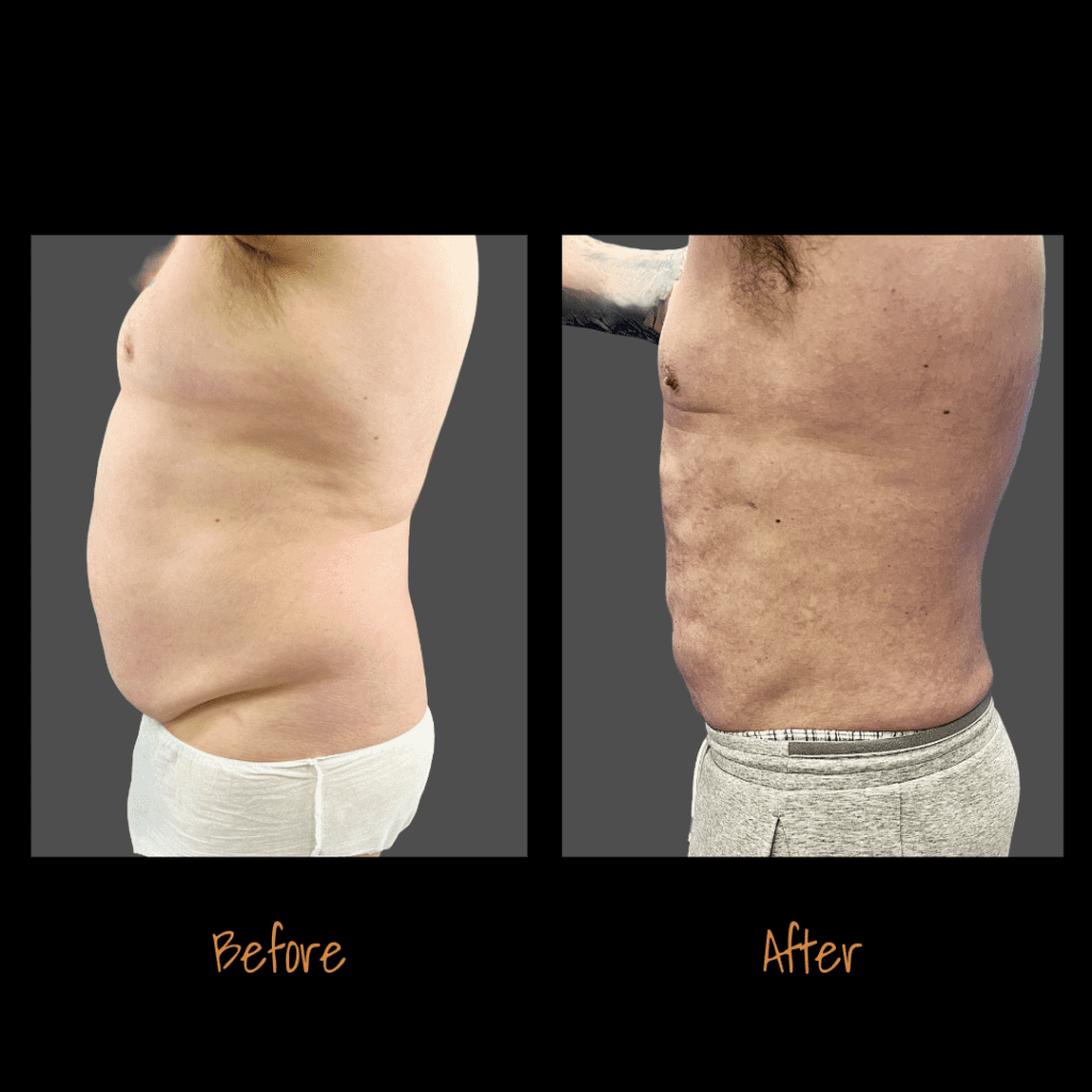 Abdomen, Flanks and Bra Rolls - Purbey