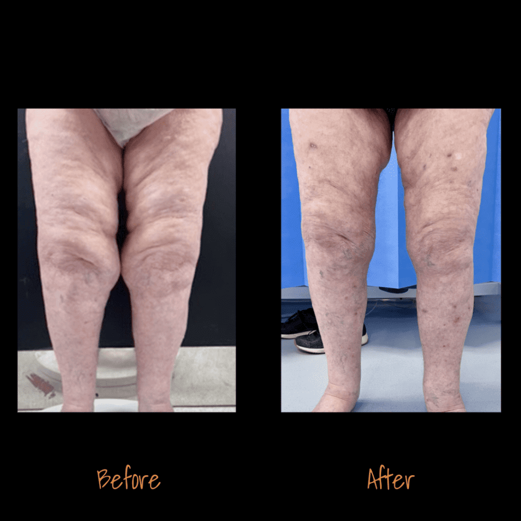 Lipoedema - Purbey