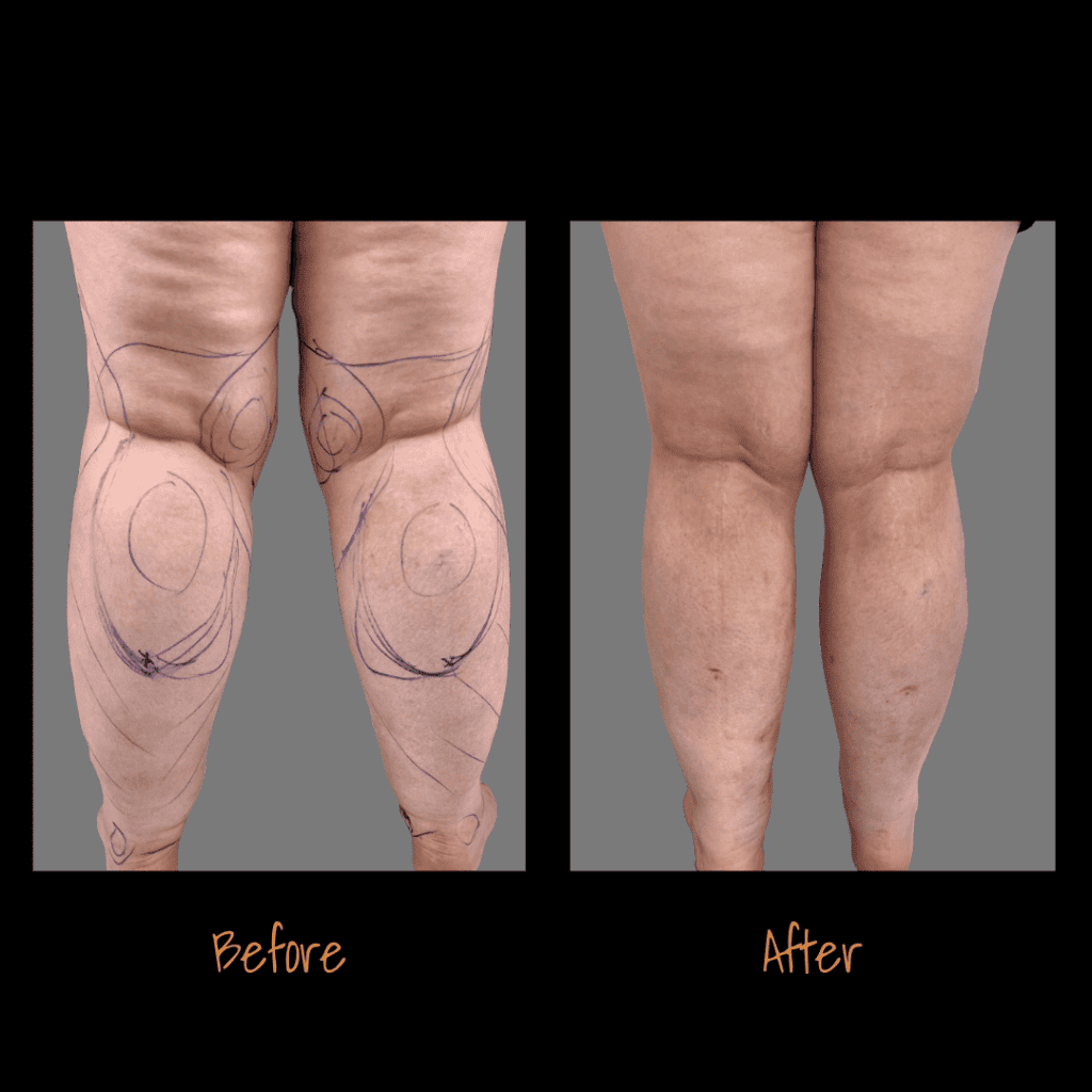 Lipoedema - Purbey
